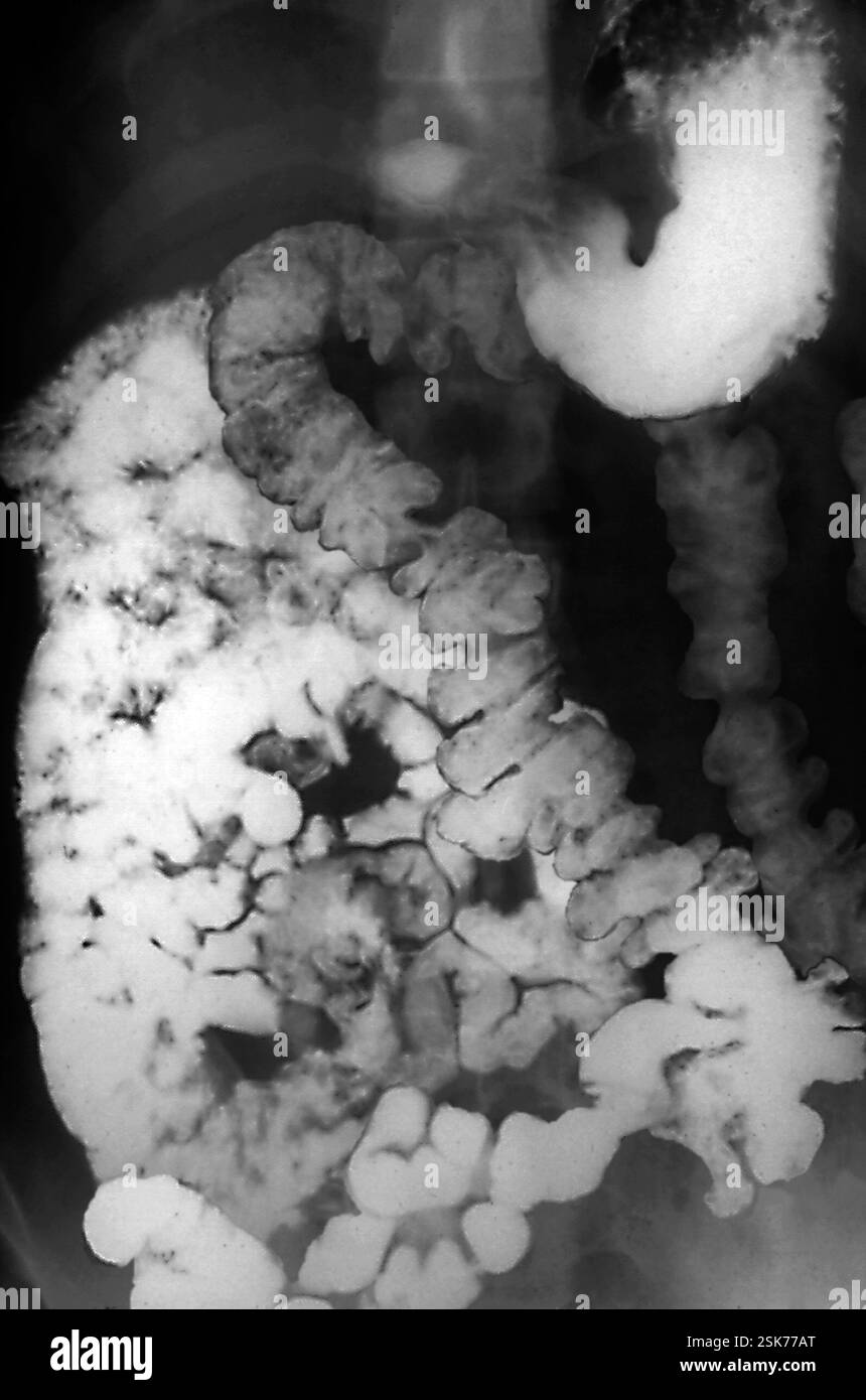 Normal small intestine. Frontal X-ray of the abdomen of an adult ...