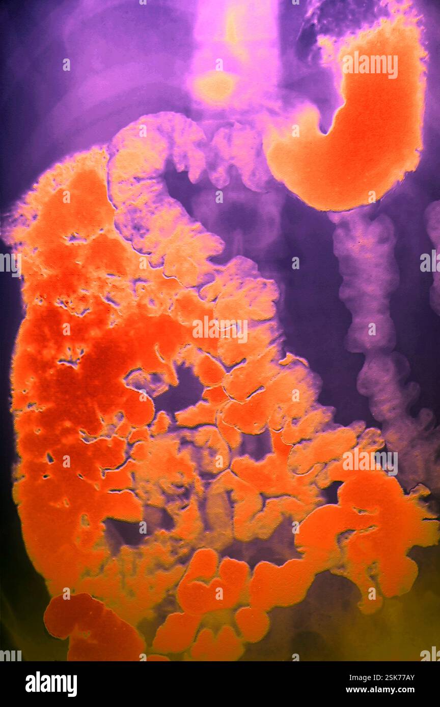 Normal small intestine, barium X-ray Stock Photo - Alamy