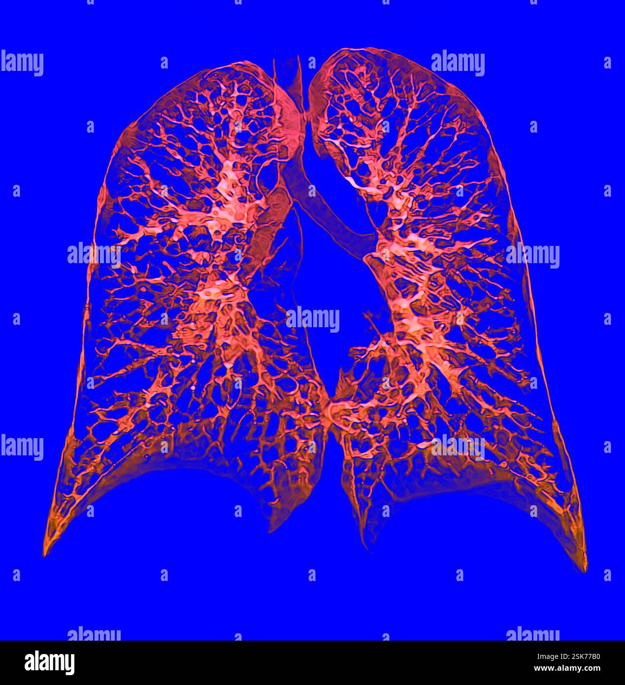Bronchial tree, coloured 3D computed tomography (CT) scan. The human ...