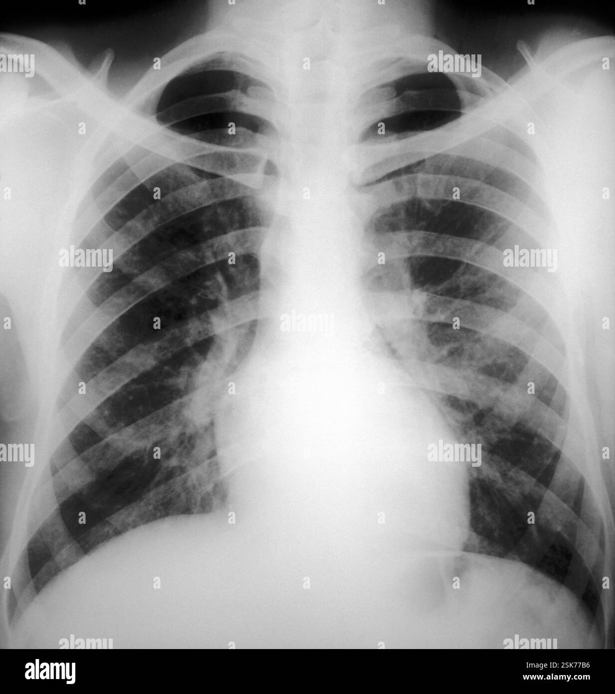 Chronic bronchitis, frontal chest X-ray. The lungs are the dark spaces ...