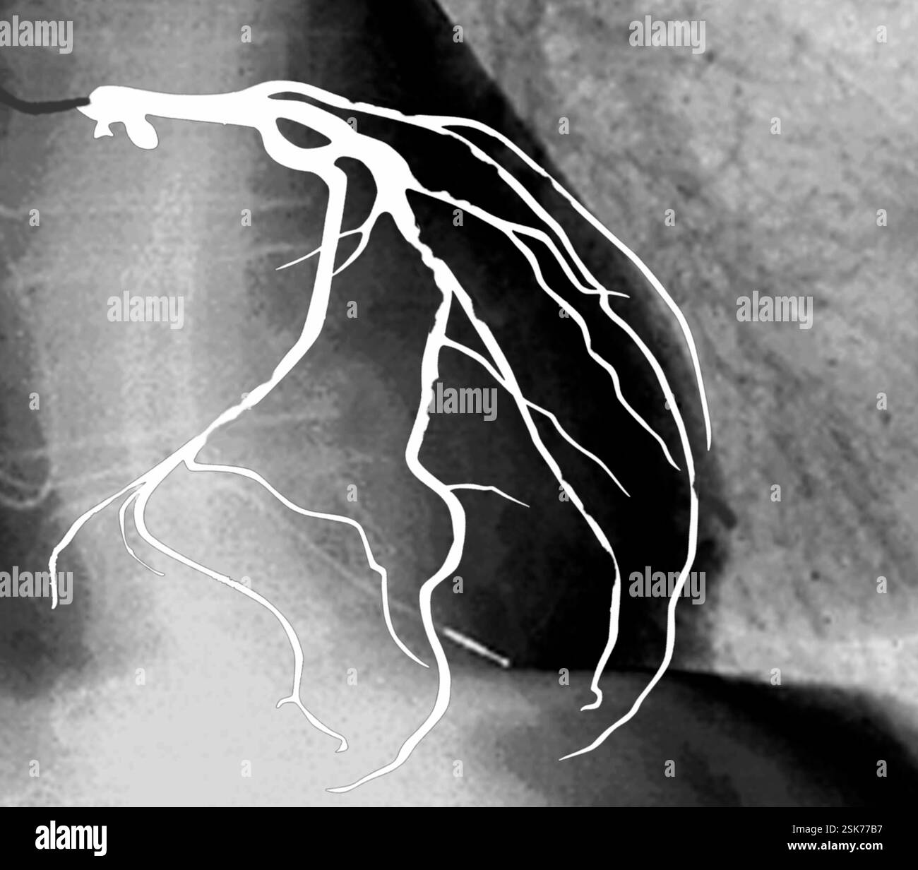 Narrowed heart artery, angiogram (X-ray). Heart of a 68-year-old man ...