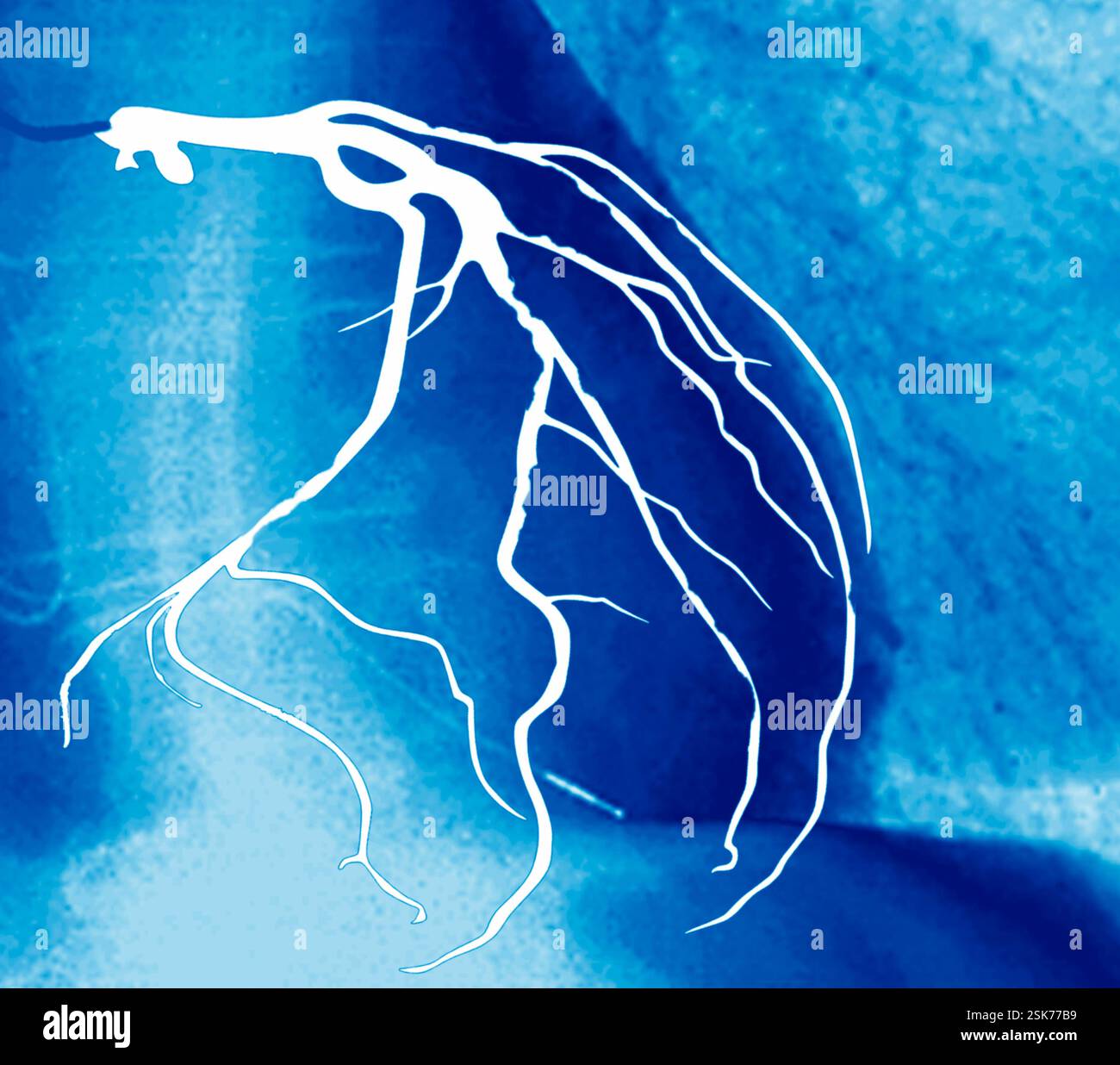 Narrowed heart artery, angiogram (X-ray). Heart of a 68-year-old man ...