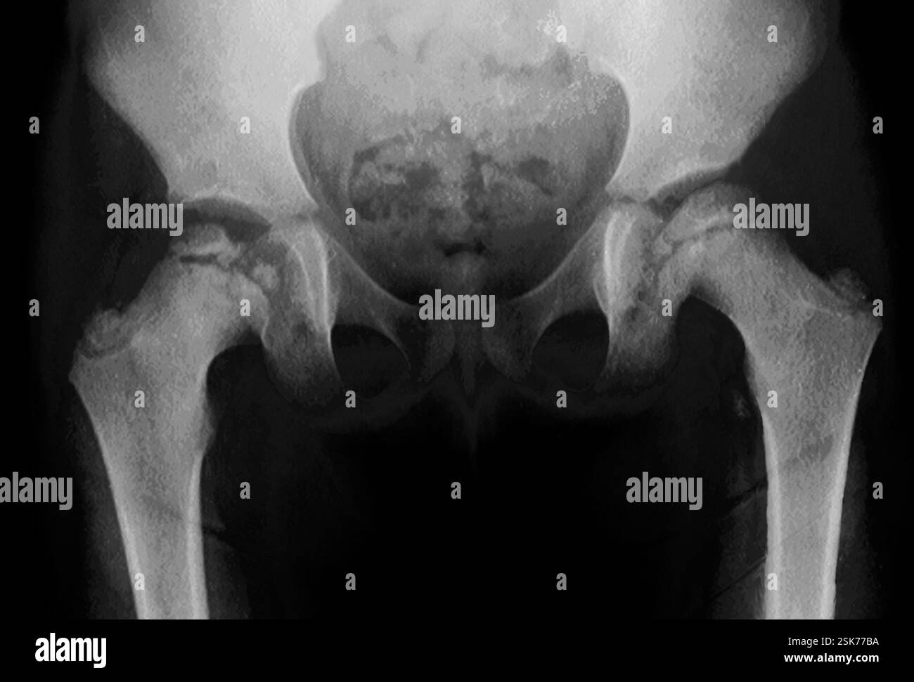 Congenital hip disorders. Frontal X-ray of a 5-year-old girl with ...