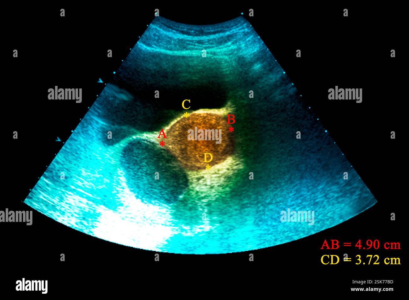 Endometrioid cyst. Coloured ultrasound scan of a cyst (orange) caused ...