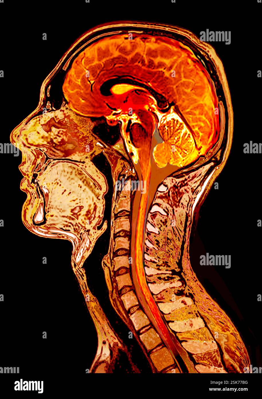 Normal brain, coloured magnetic resonance imaging (MRI) scan. Sagittal (side) view of a human ...