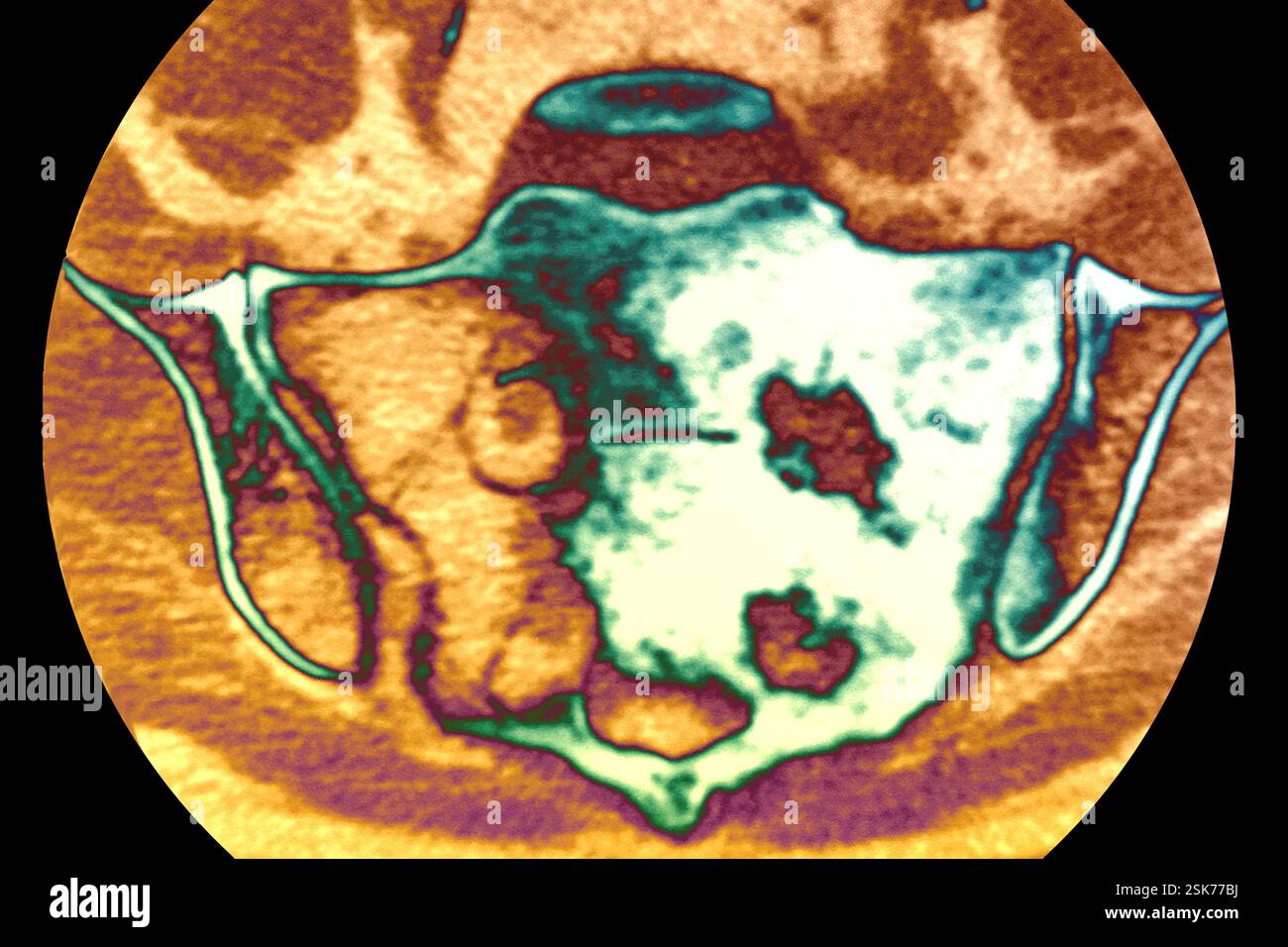 Urine reflux, X-ray Stock Photo - Alamy