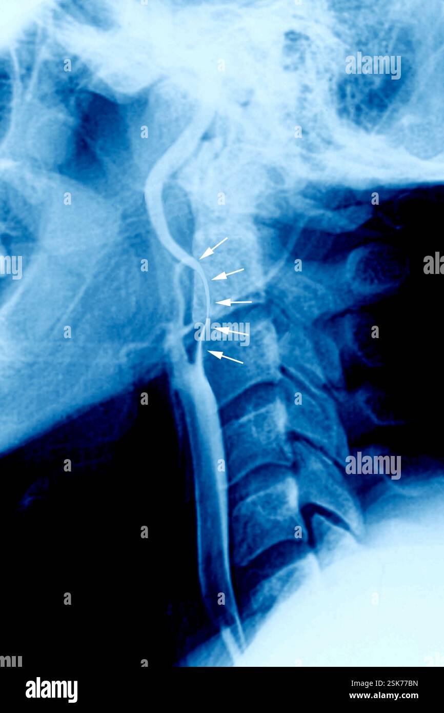 Carotid artery tear. Lateral digital angiogram (X-ray) of a 43-year-old ...