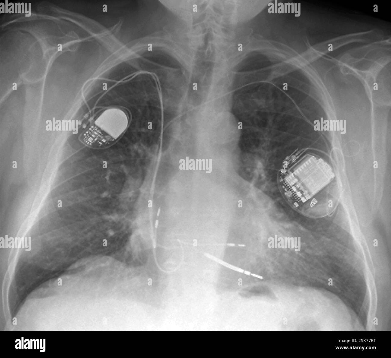 Cardiac stimulator and pacemaker. Frontal chest X-ray of a 57-year-old ...