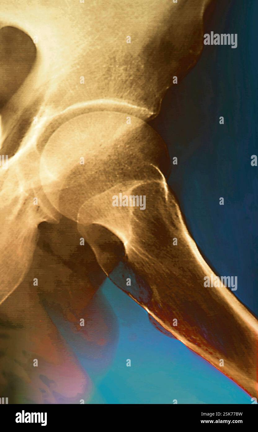 Normal hip. Lateral X-ray of the normal left hip of a 35-year-old man ...