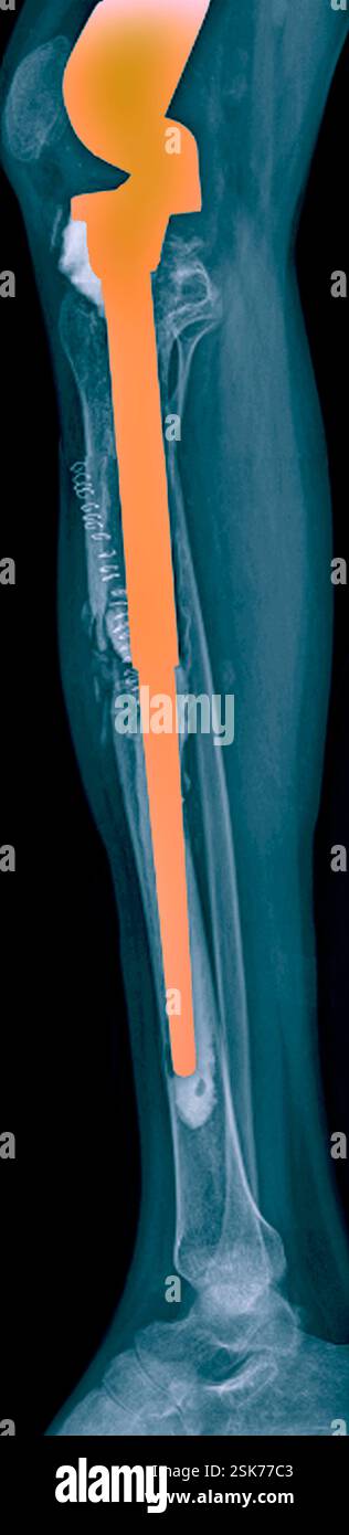 Knee replacement and tibial pin, coloured X-ray. This side view of the ...