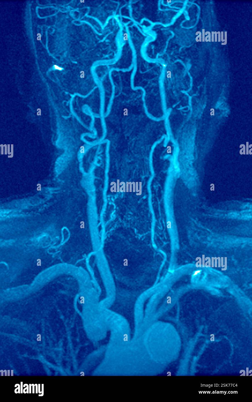 Narrowed neck artery. Coloured frontal magnetic resonance imaging (MRI ...