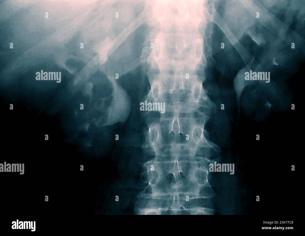 Kidney cancer. Urogram (X-ray) of the abdomen of a patient with cancer ...