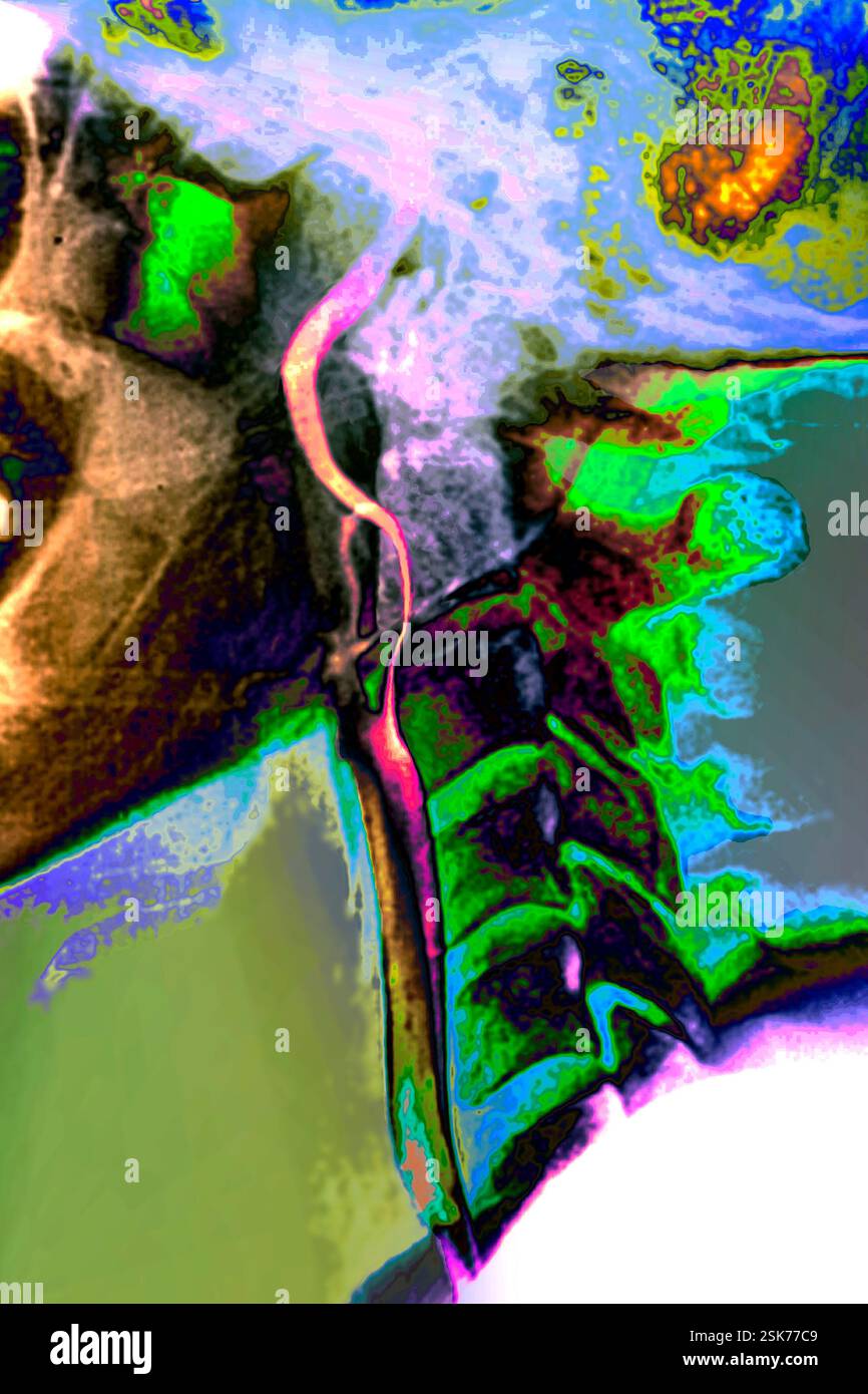 Carotid artery tear, X-ray Stock Photo - Alamy