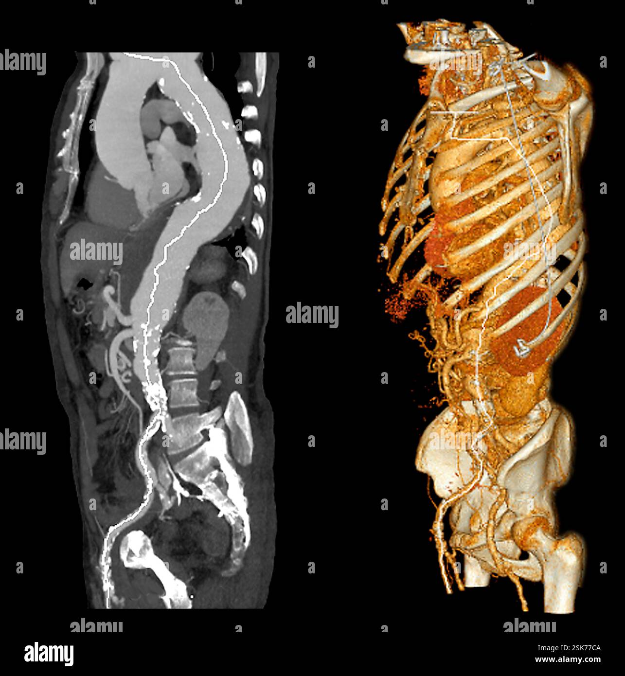Aortic aneurysm, 2D (left) and coloured 3D (right) sagittal computed ...