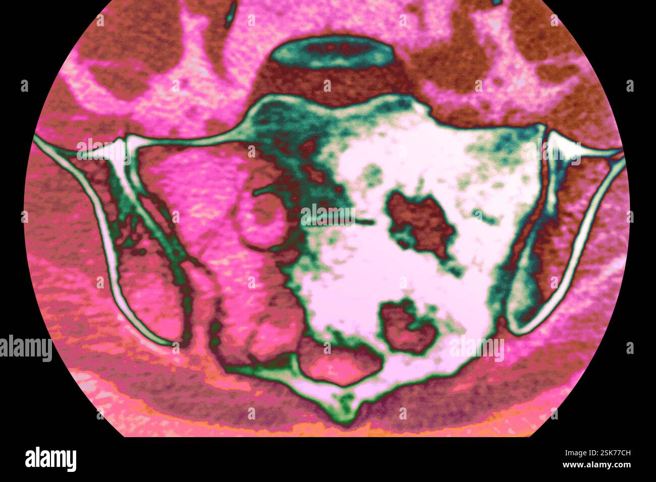 Inflamed kidney, light micrograph Stock Photo - Alamy
