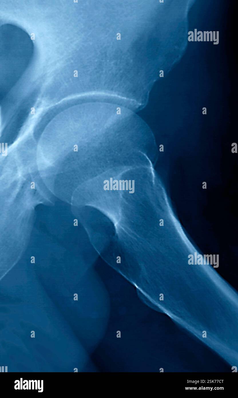 Normal hip. Lateral X-ray of the normal left hip of a 35-year-old man ...