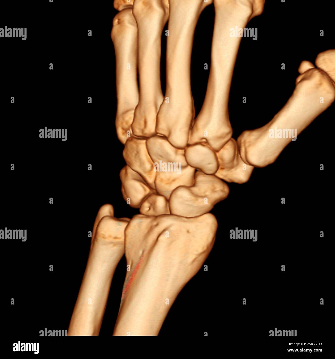 Coloured three-dimensional (3D) Computed Tomography (CT) scan in top ...