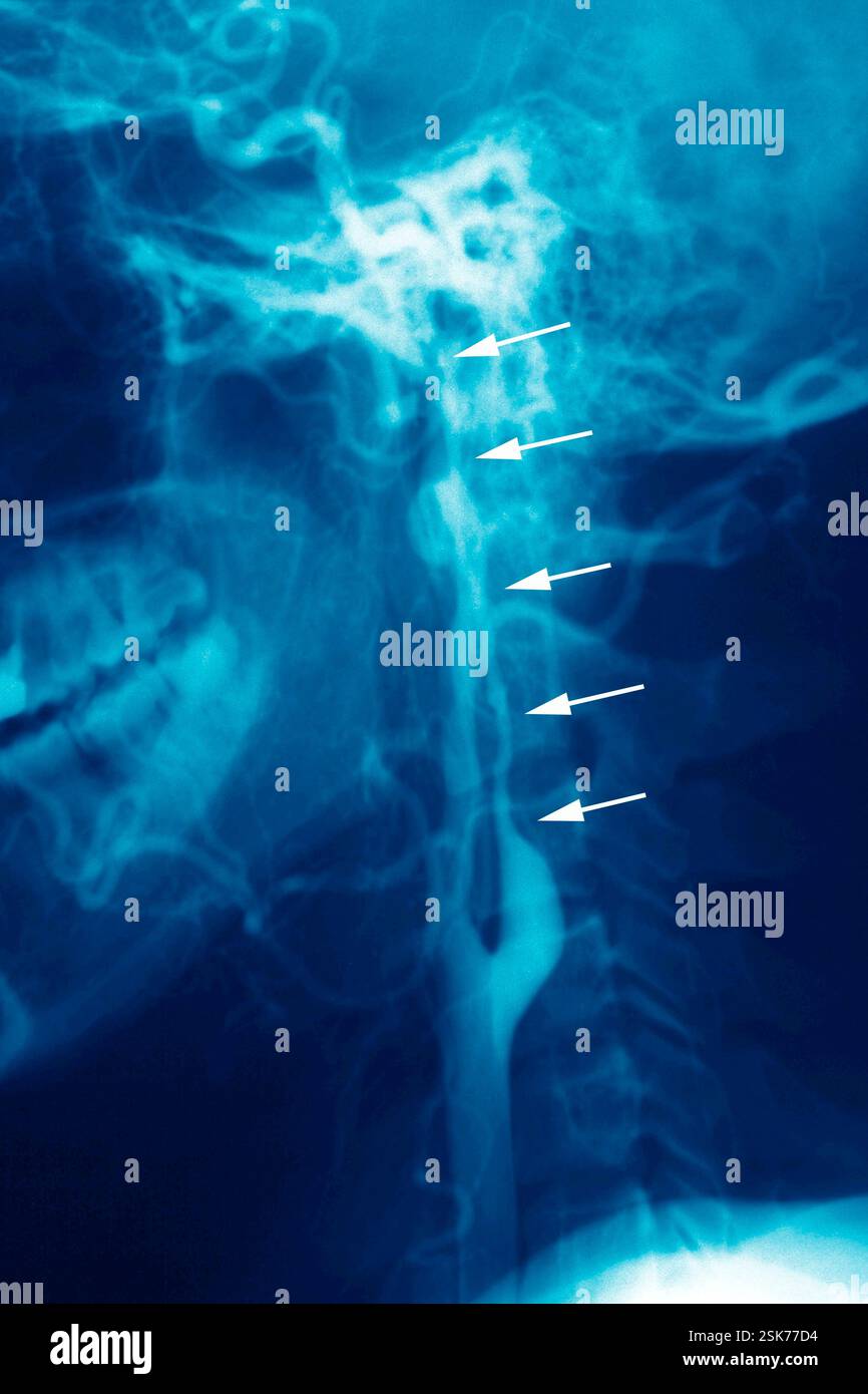 Carotid artery tear. Coloured lateral digital angiogram (X-ray) of a 43 ...