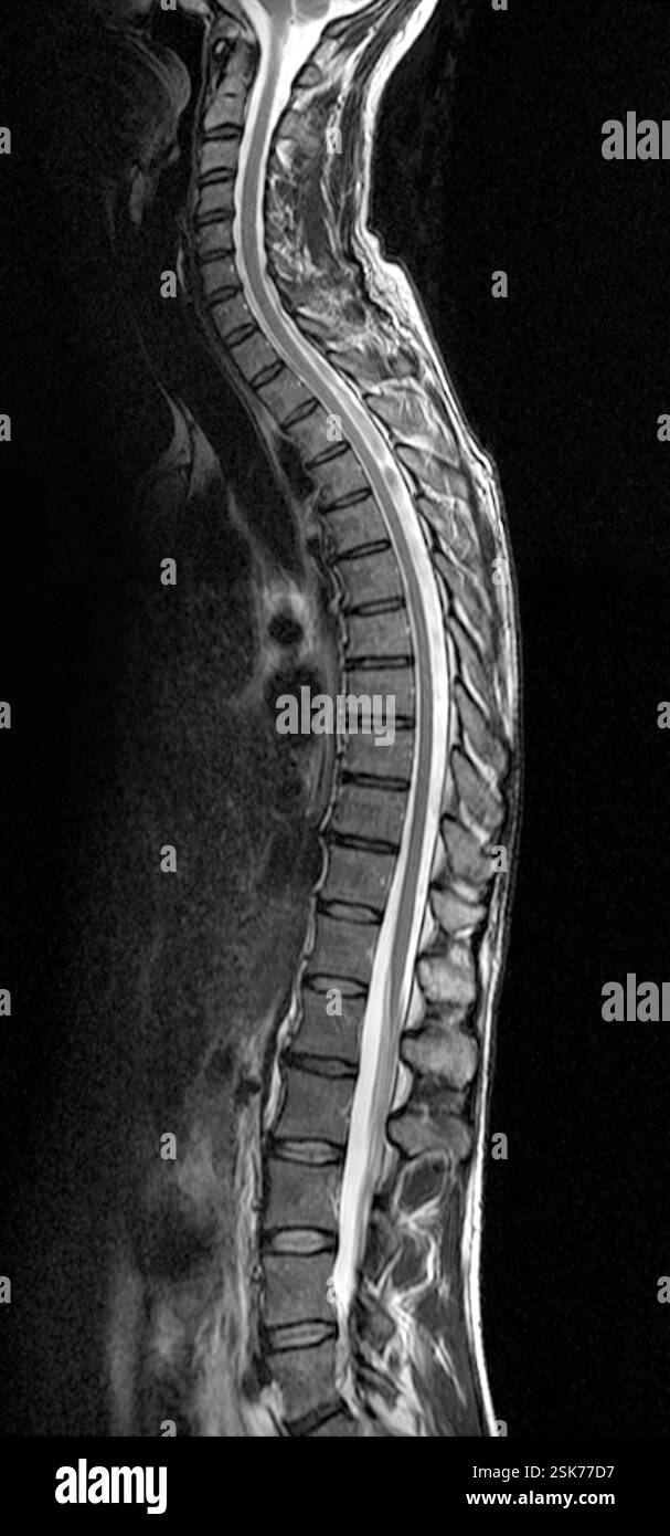 Normal spine, MRI scan Stock Photo - Alamy