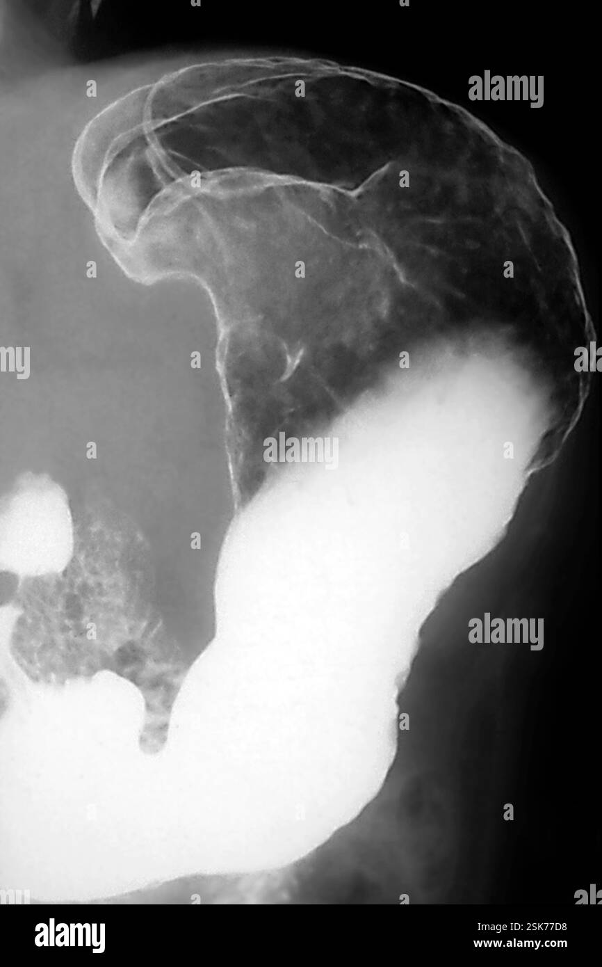 Stomach cancer. Frontal X-ray of the upper gastroduodenal tract of a ...