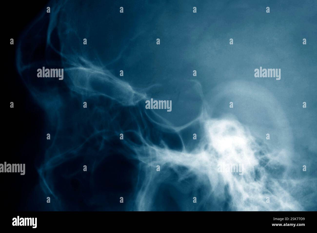 Multiple sclerosis, MRI brain scan Stock Photo - Alamy