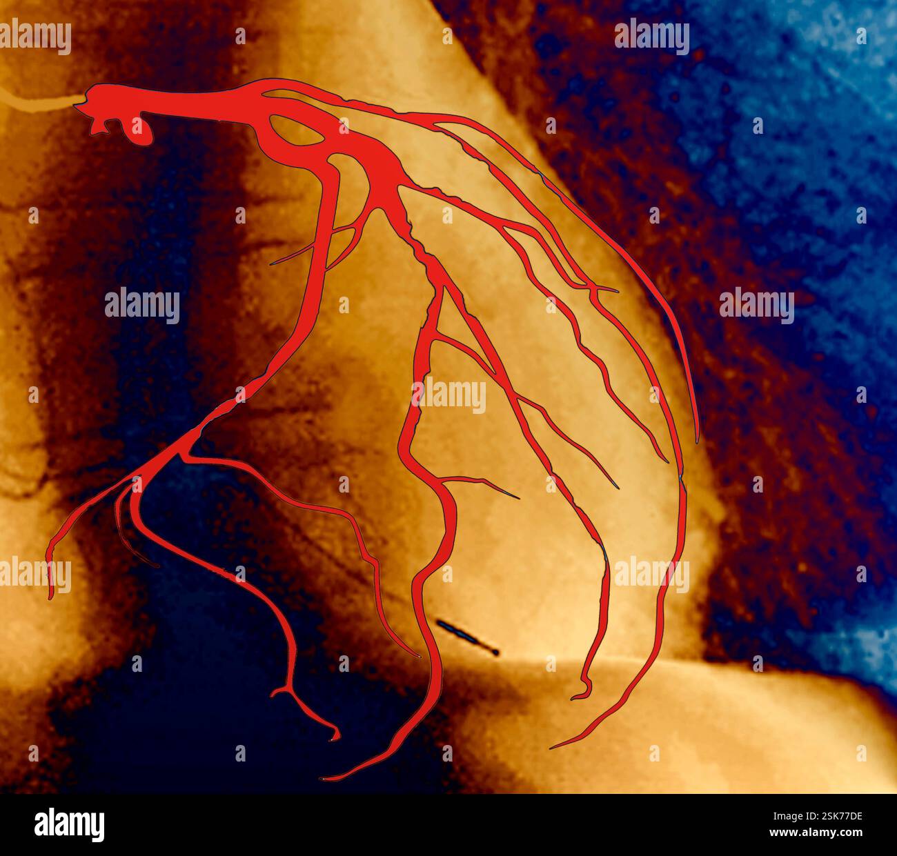 Narrowed heart artery, angiogram (X-ray). Heart of a 68-year-old man ...