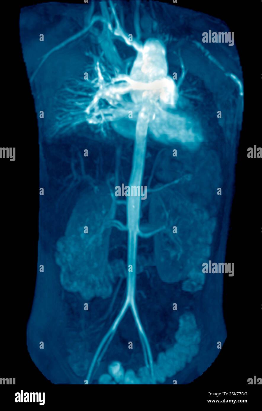 Healthy brain, SPECT scans Stock Photo - Alamy
