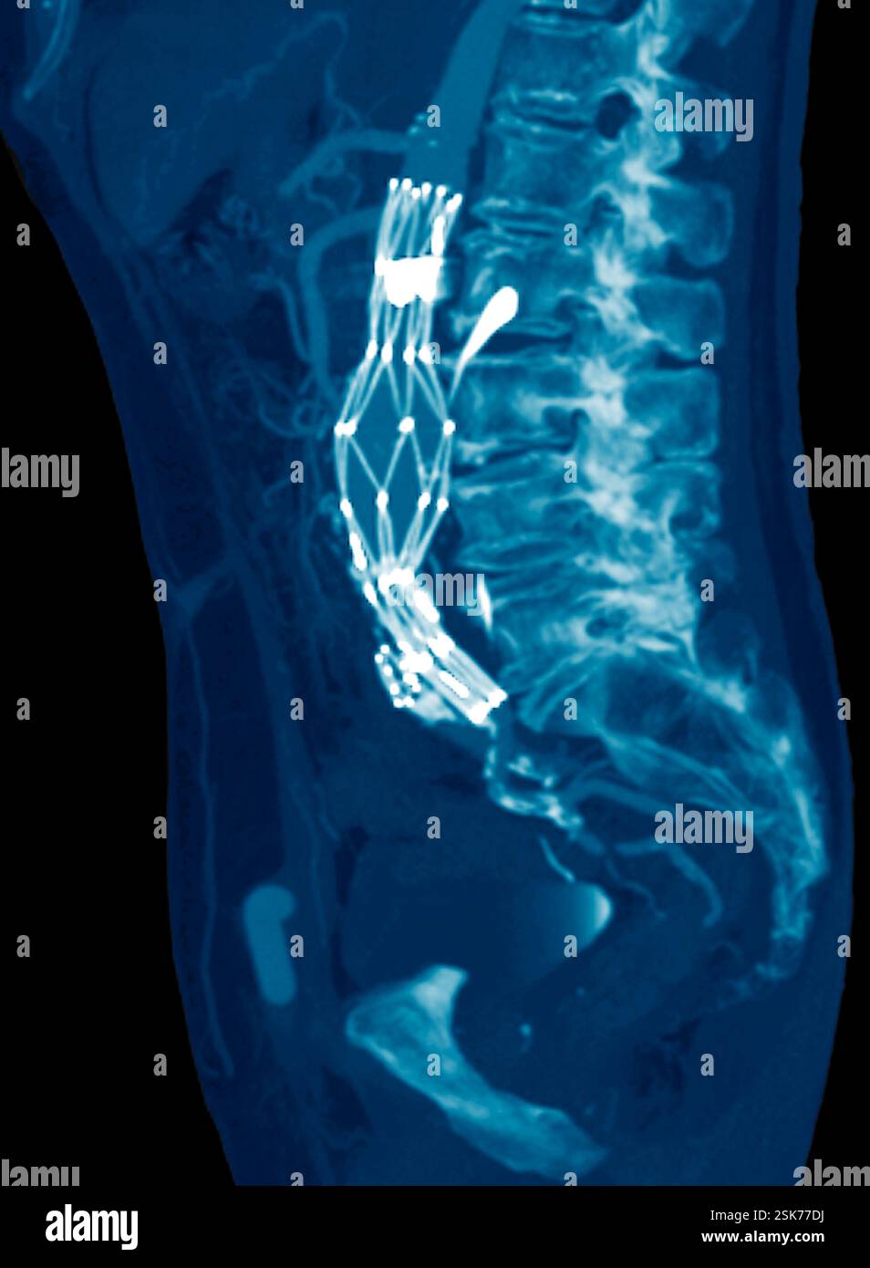 Healthy brain, SPECT scans Stock Photo - Alamy