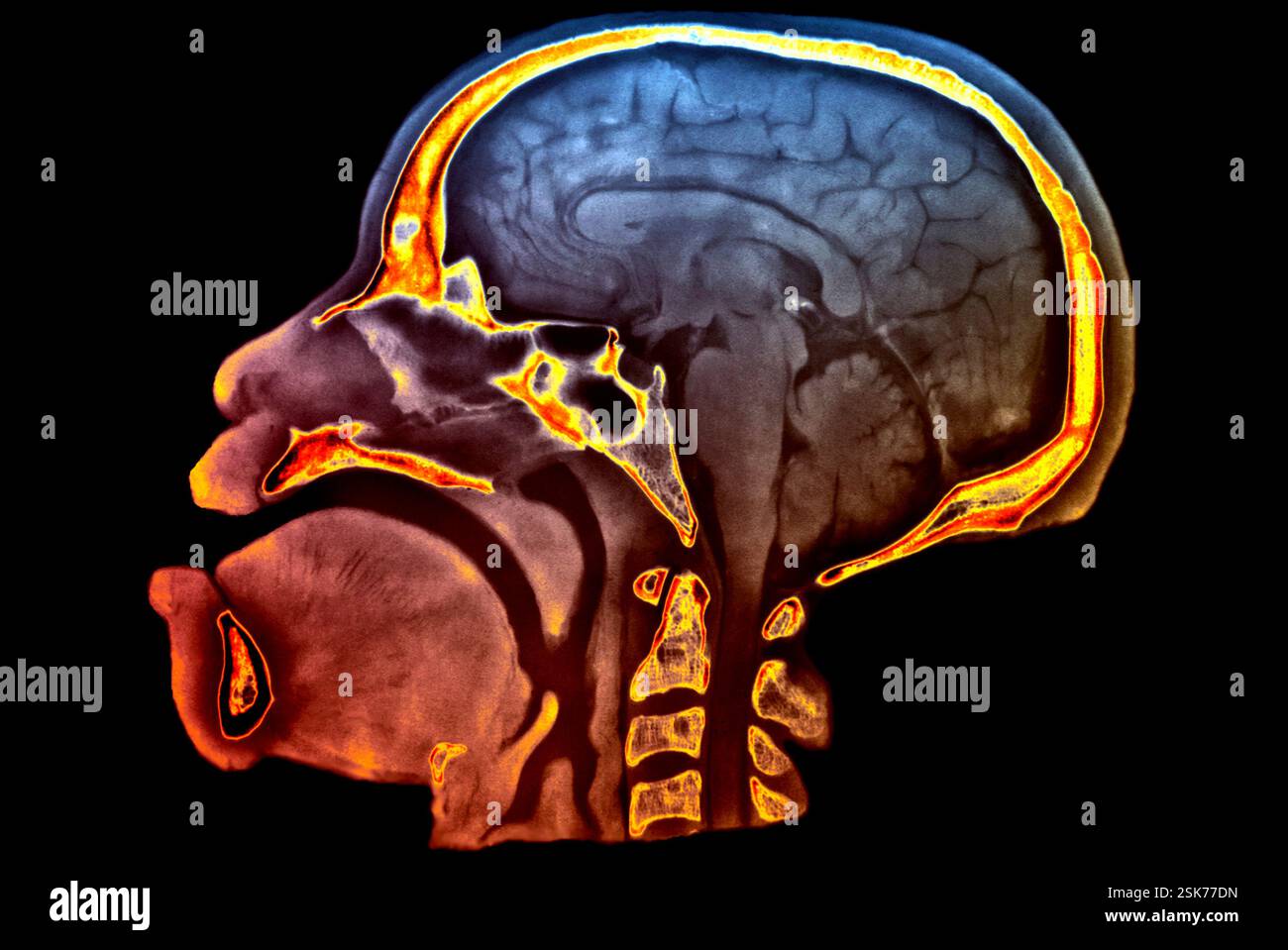 Heart attack, SPECT scan Stock Photo - Alamy
