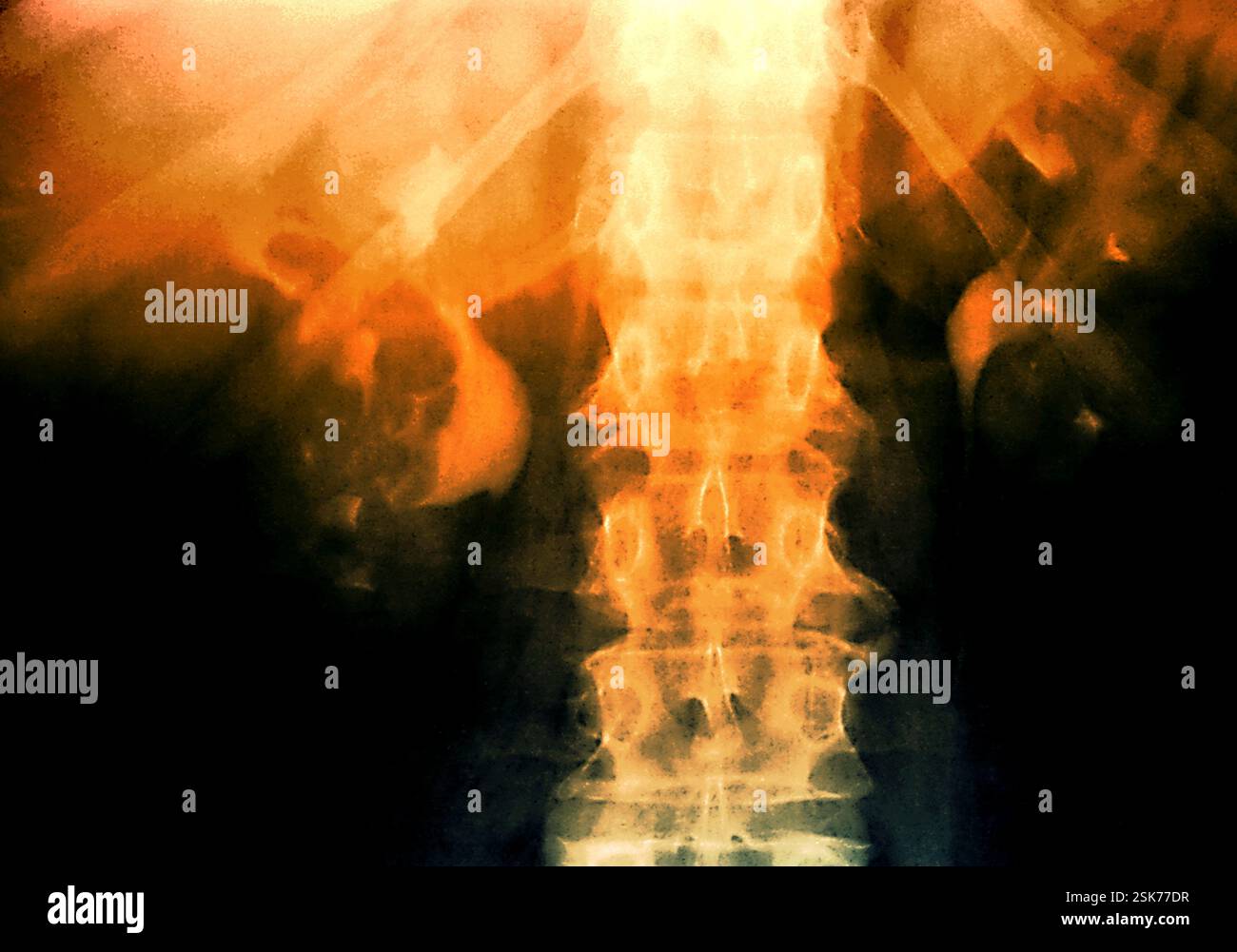 Kidney cancer. Coloured urogram (X-ray) of the abdomen of a patient ...