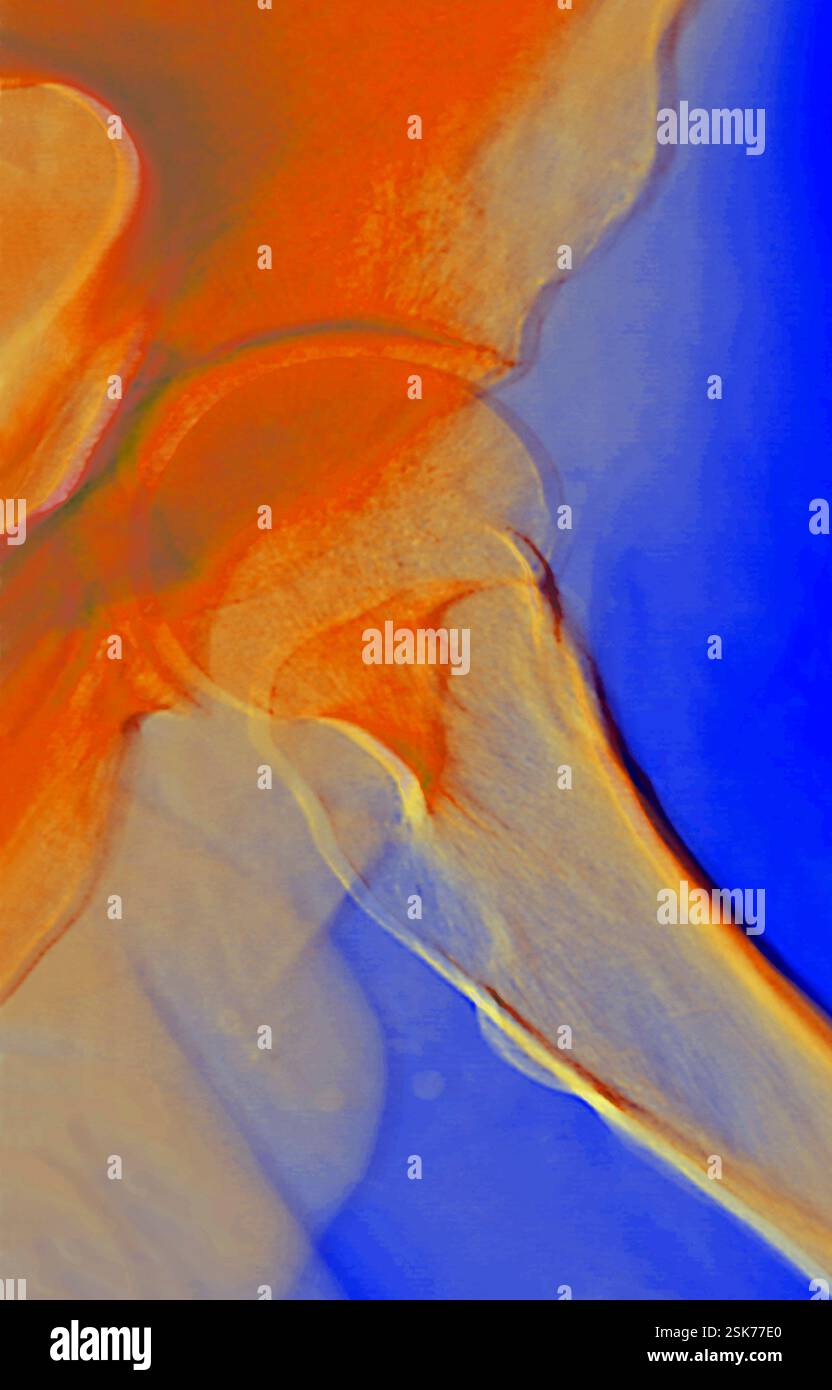 Normal hip. Lateral X-ray of the normal left hip of a 35-year-old man ...