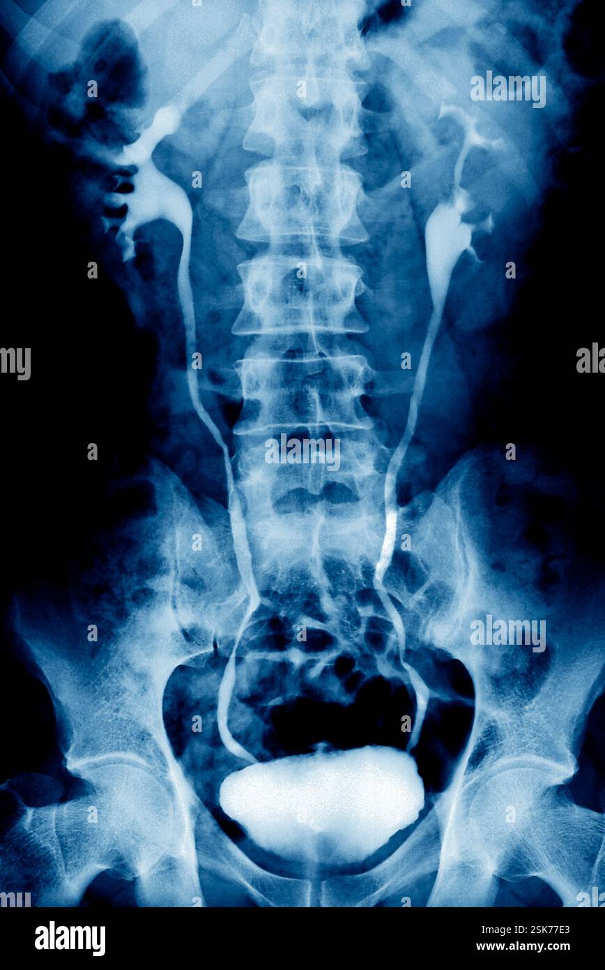 Urinary tract. Coloured urogram (X-ray) of a healthy urinary tract. At ...