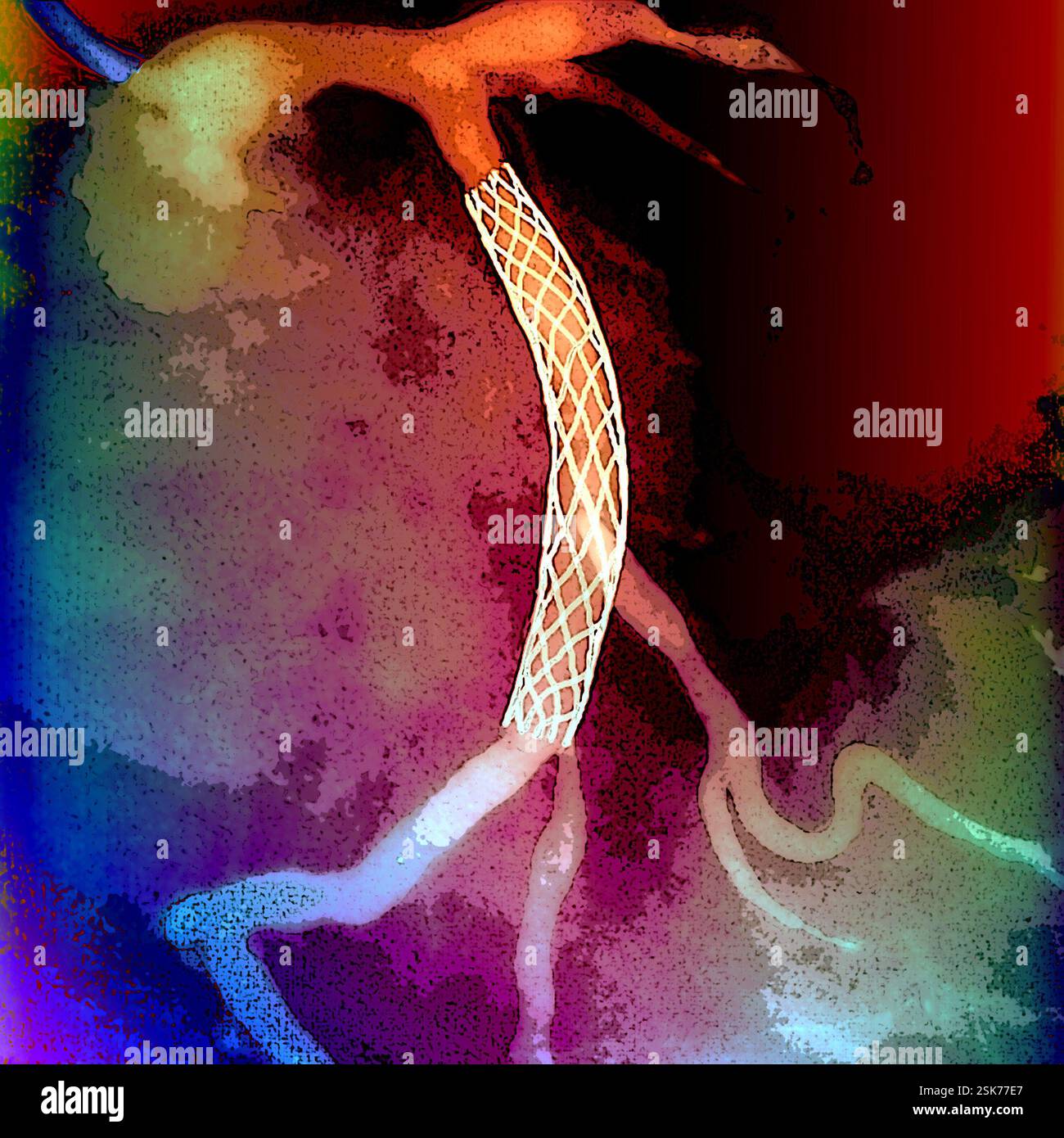 Stent in a coronary artery. Coloured X-ray of a stent (white) that has ...