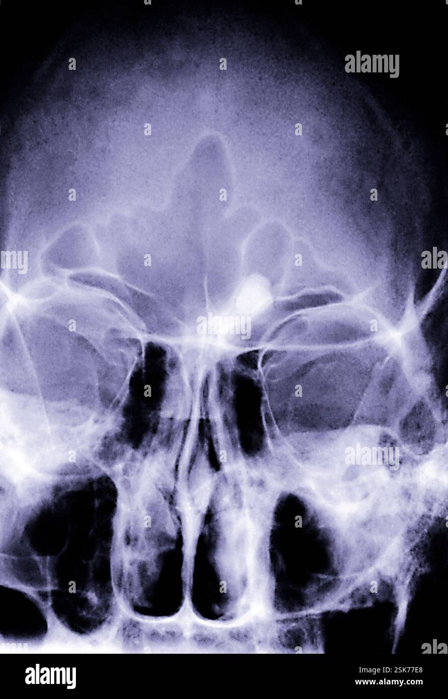 Bony growth in the frontal sinus. X-ray of the head of a patient with an osteoma (bony growth ...