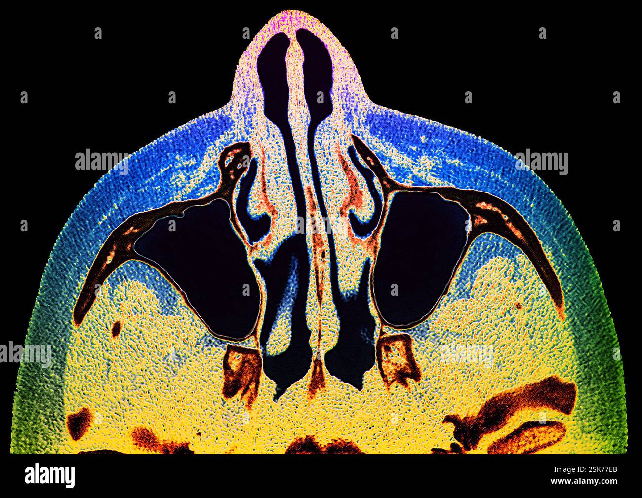 Maxillary sinuses, CT scan Stock Photo - Alamy