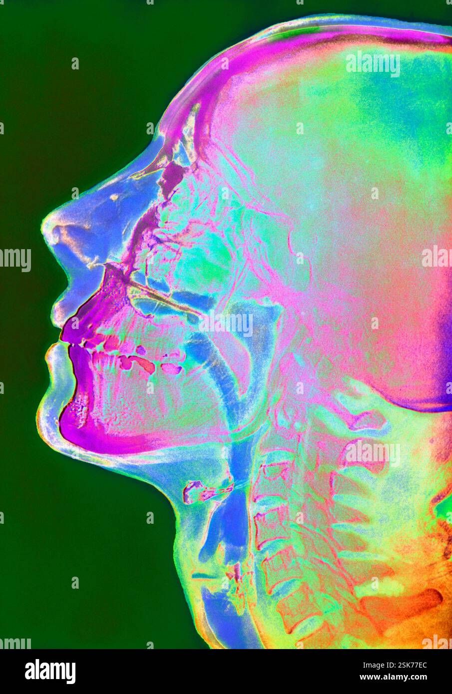 Nose and throat passages. Coloured xeroradiogram of a human head and ...