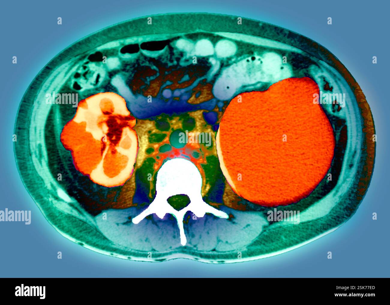 Polycystic kidneys. Coloured computed tomography (CT) scan of the abdomen of a patient with ...