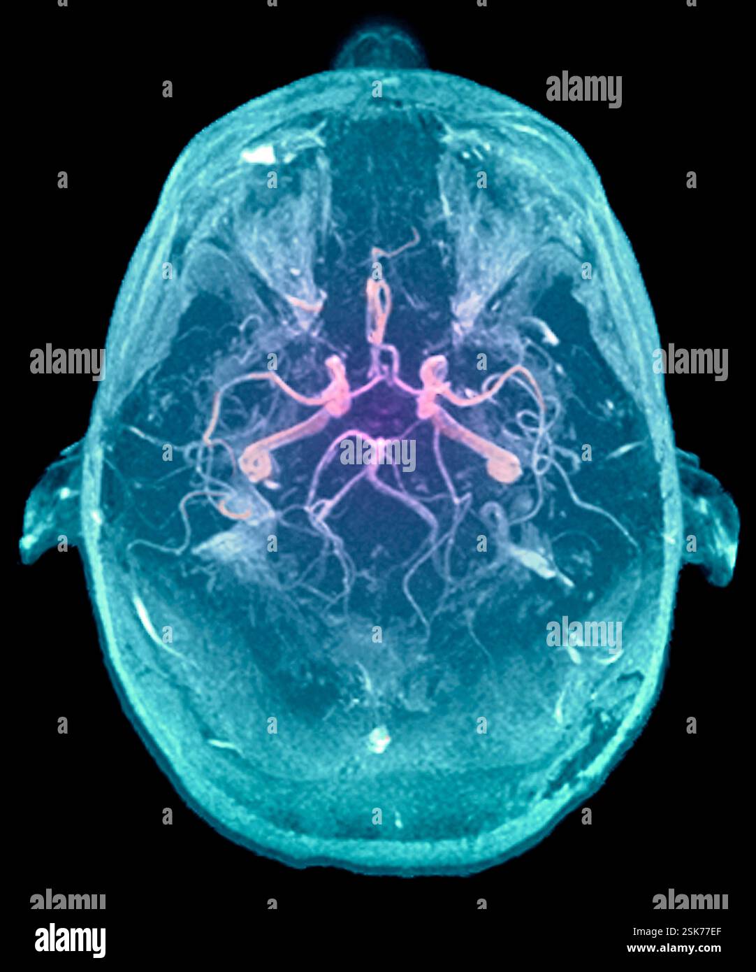 Brain arteries, 3D MRI scan Stock Photo - Alamy