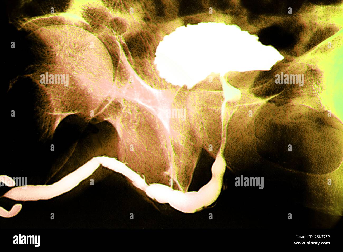 Urethritis. Coloured urogram (X-ray) of the pelvis of a male patient ...