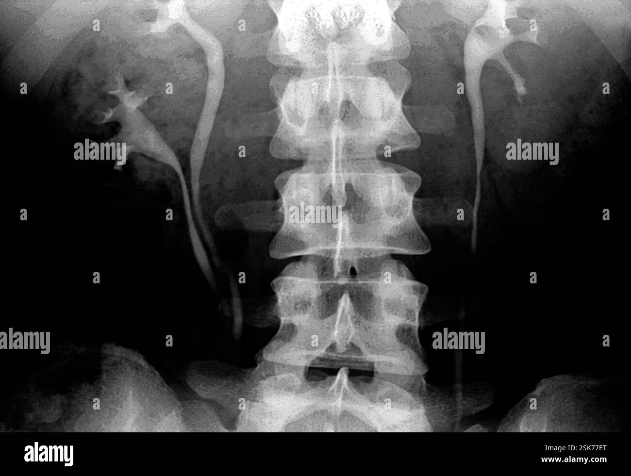 Double ureter anomaly. Urogram (X-ray) of the abdomen of a patient with ...