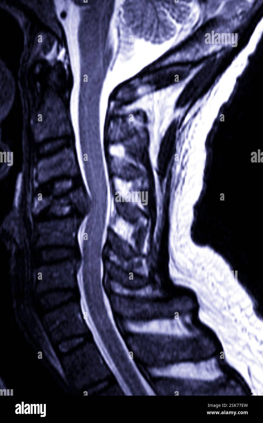 Multiple sclerosis, MRI brain scan Stock Photo - Alamy