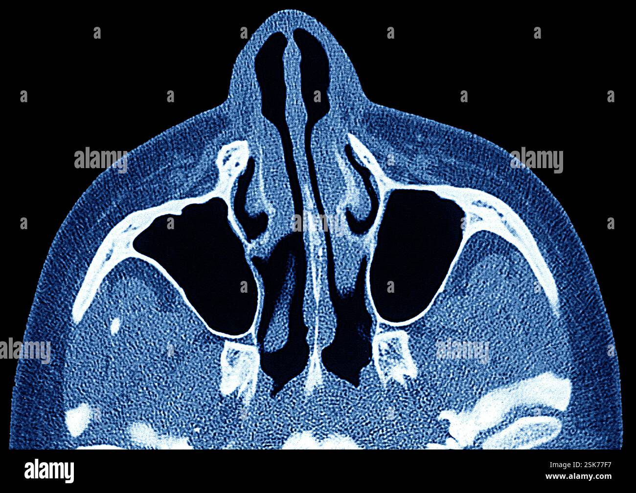 Maxillary sinuses. Computed tomography (CT) scan through the front of a ...