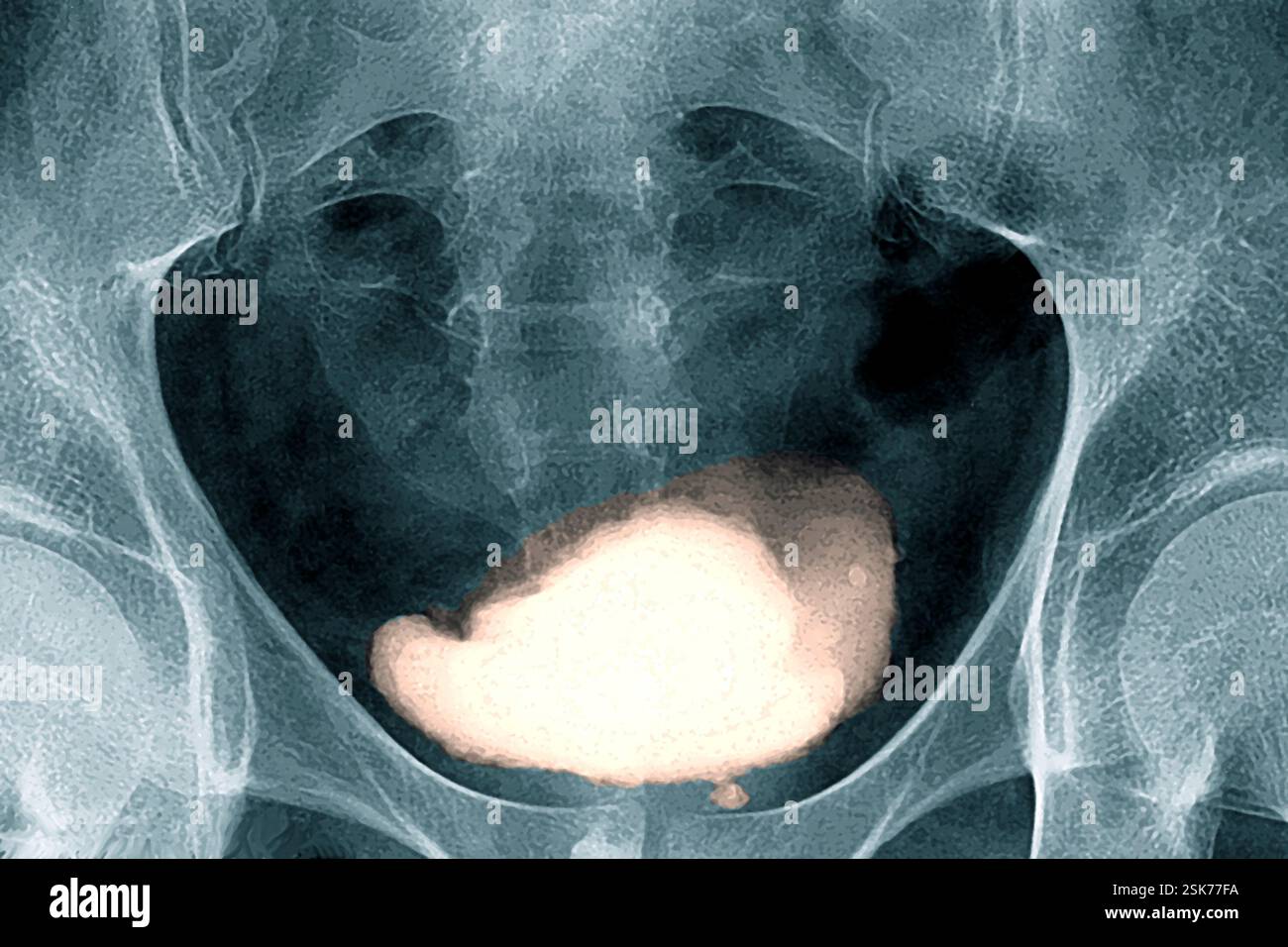 Bladder tuberculosis. Coloured urogram (X-ray) of the pelvis of a ...