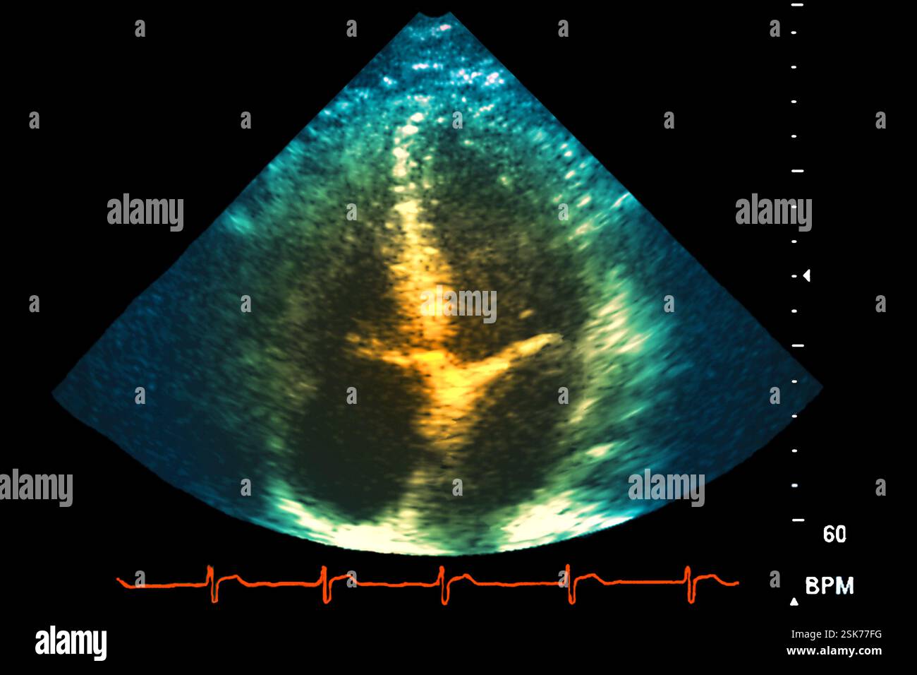 Normal heart. Coloured ultrasound scan of a healthy heart. This scan ...