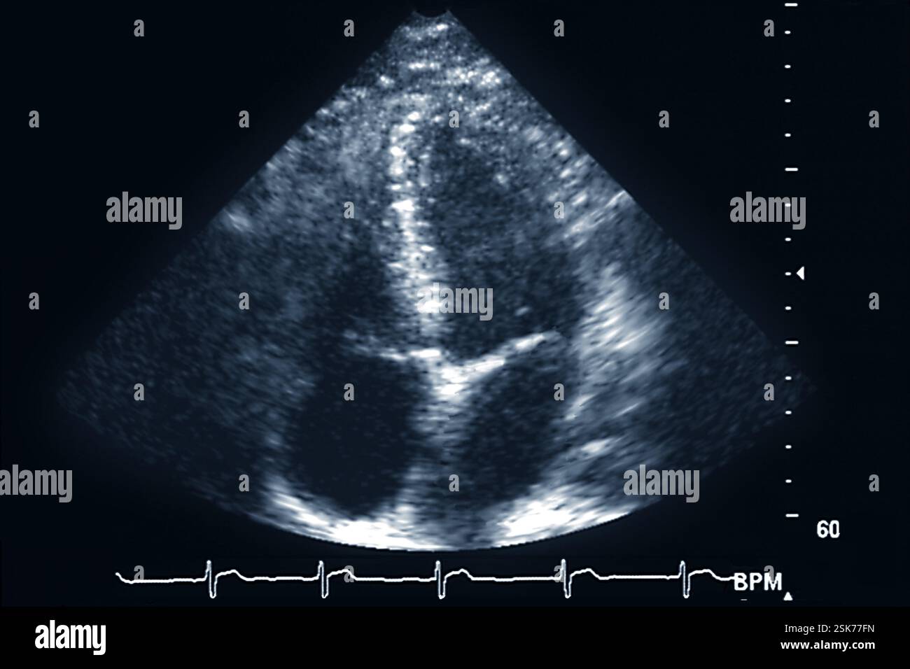 Normal heart. Ultrasound scan of a healthy heart. This scan passes ...