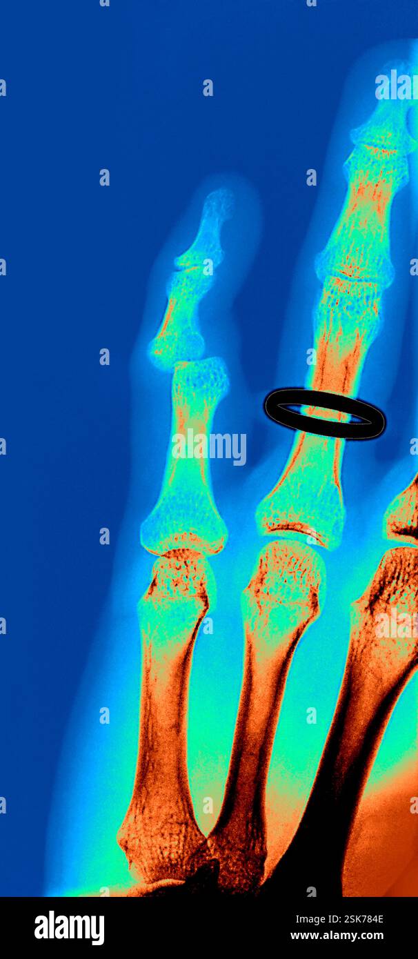 Coloured X-ray (top view) of the left hand of a patient, showing ...