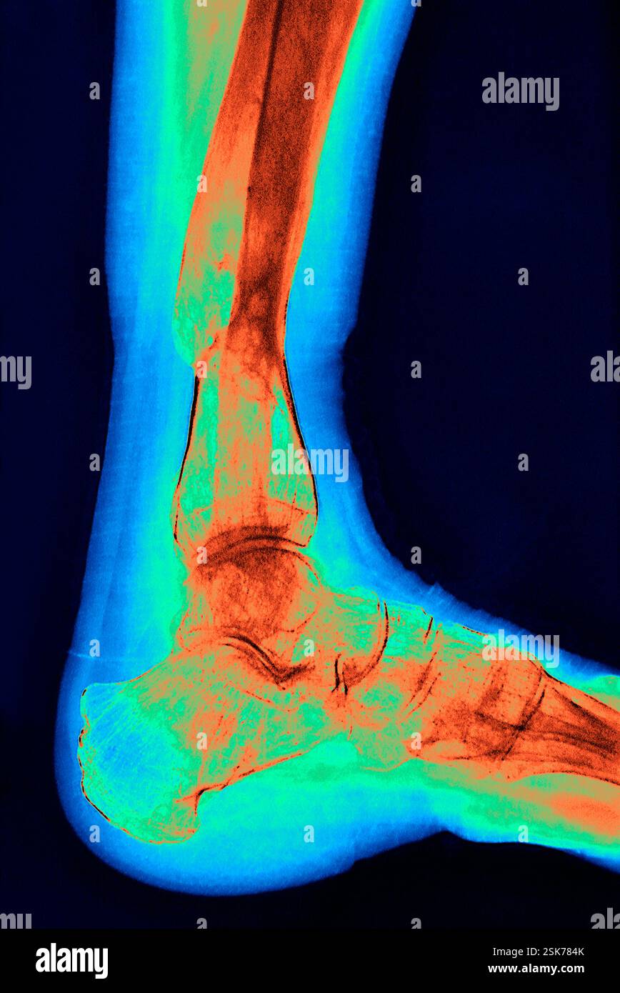 Coloured X-ray (side view) of the ankle of a patient aged 70, showing ...