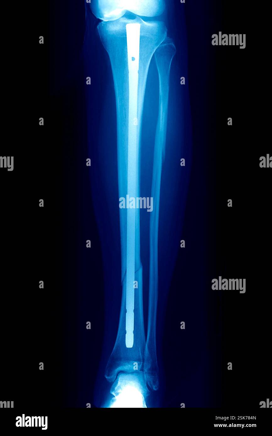 Coloured X-ray (front view) of the left leg of a female patient ...
