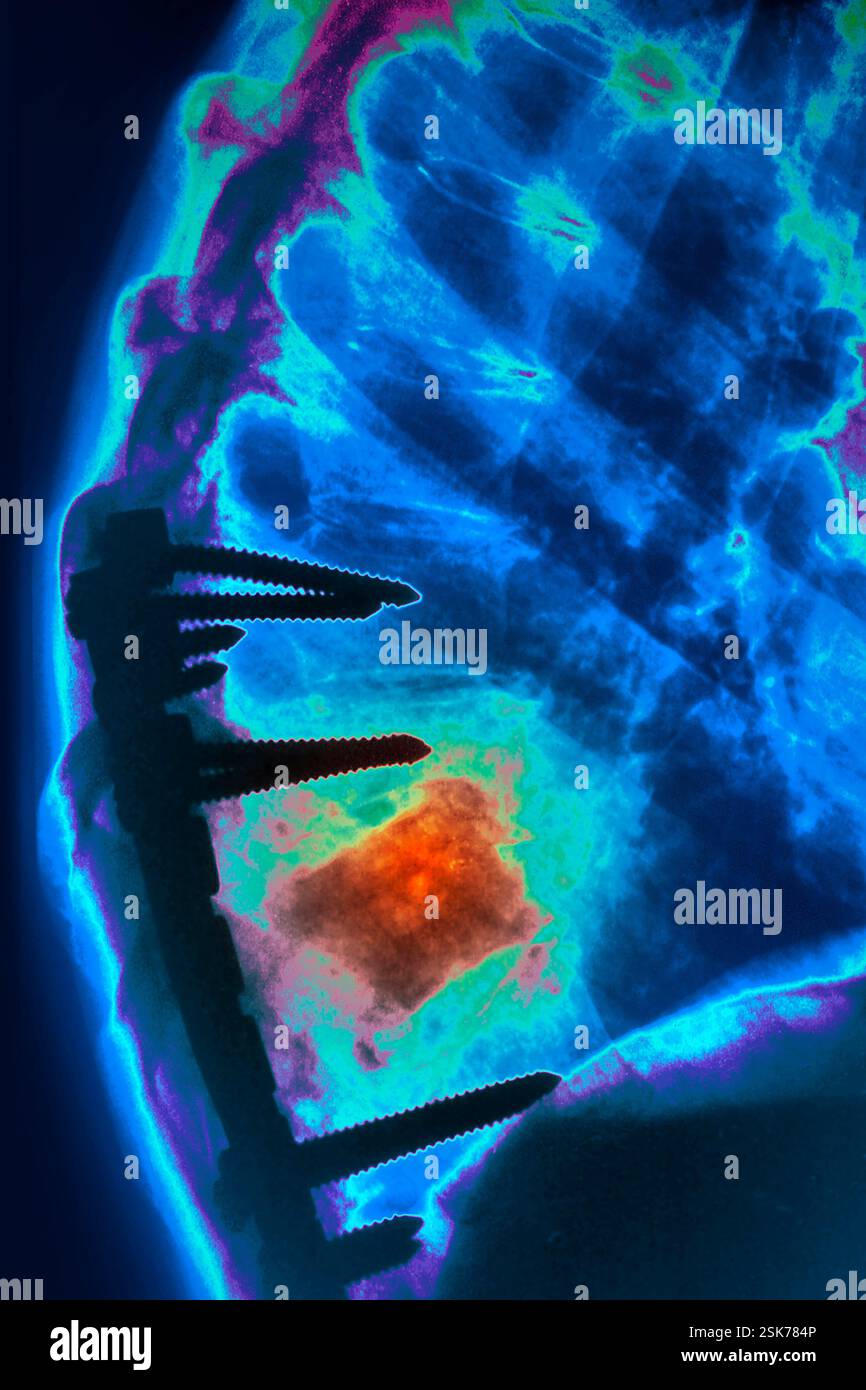 Coloured X-ray (side view) of the spine of an adult patient, showing a ...