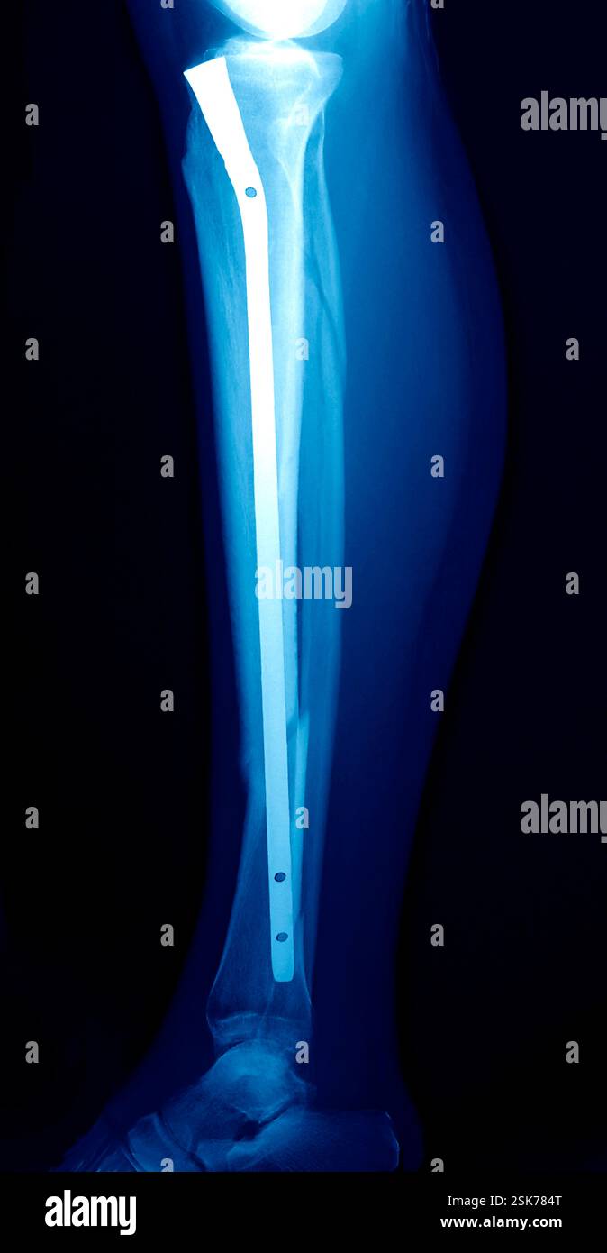 Coloured X-ray (side view) of the left leg of a female patient, showing ...